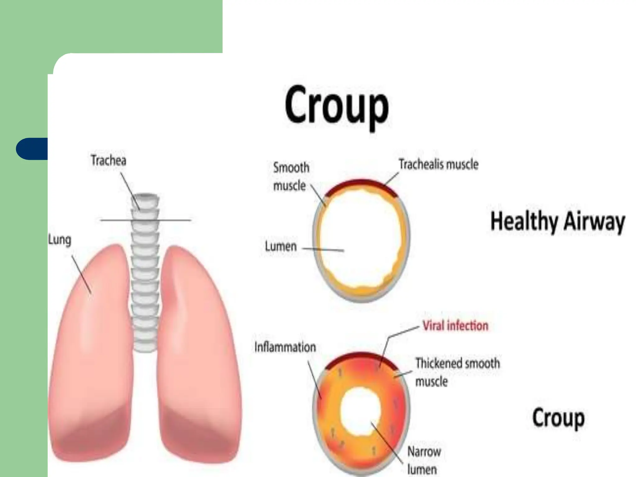 Croup syndrome.pptx