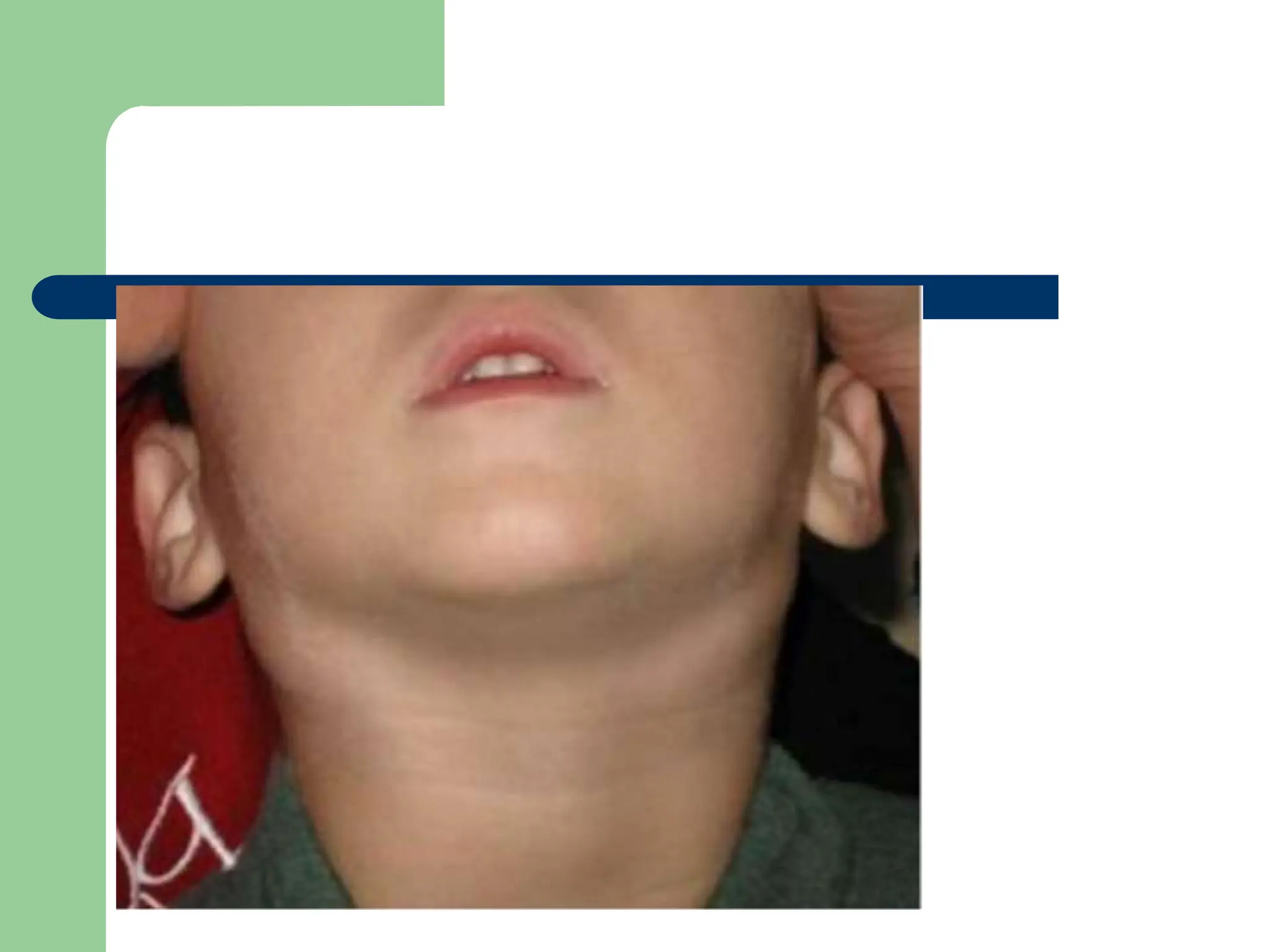 Croup syndrome.pptx