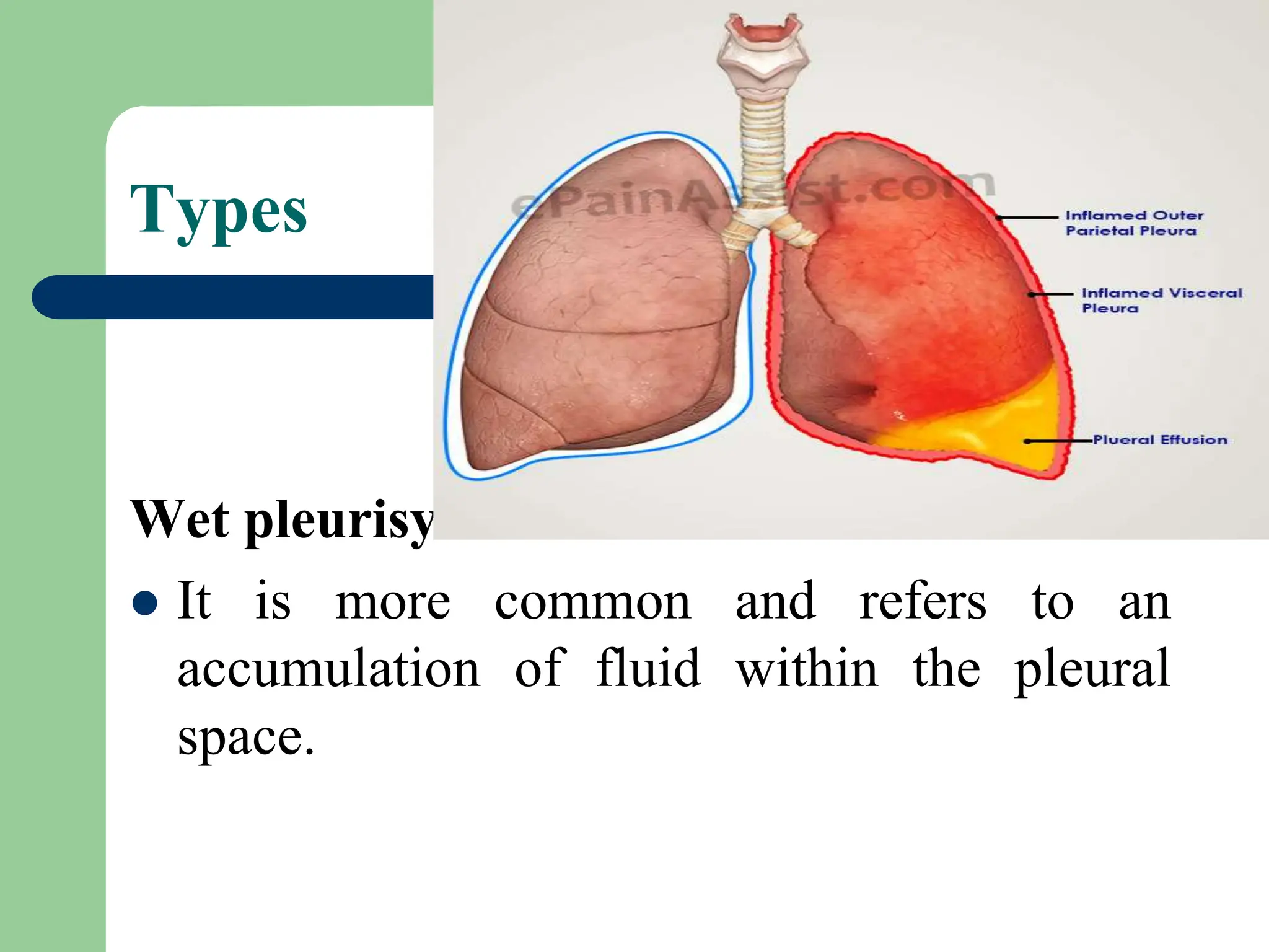 Croup syndrome.pptx