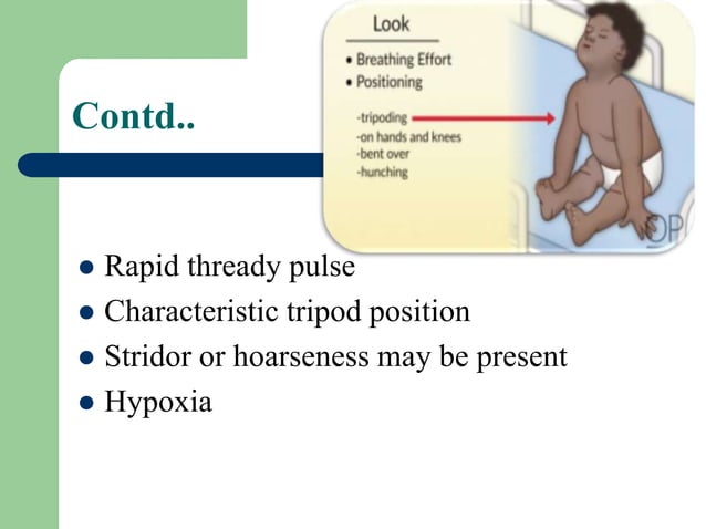 Croup syndrome.pptx