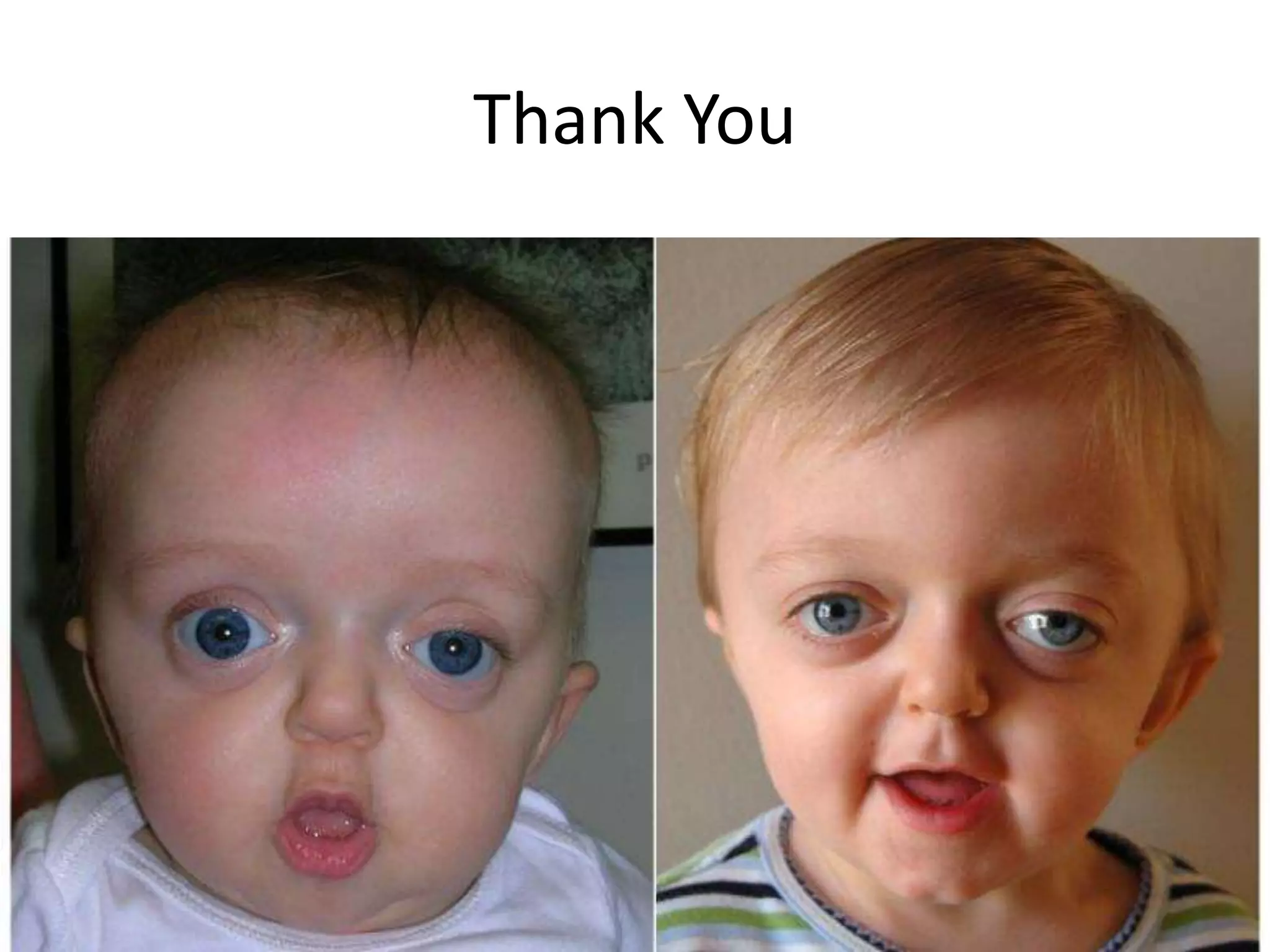 Crouzon syndrome | PPTX