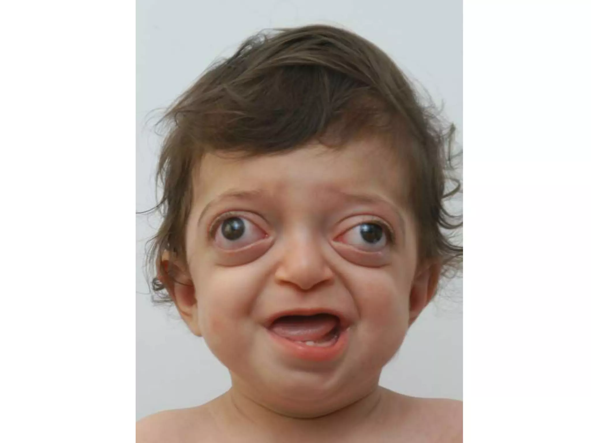 Crouzon syndrome | PPTX