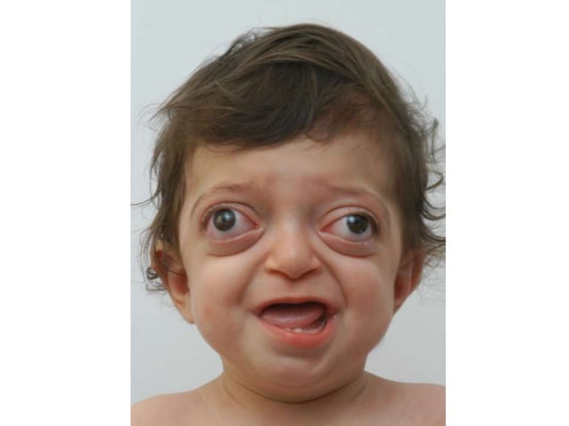Crouzon syndrome | PPTX | Ear, Nose and Throat Conditions | Diseases ...