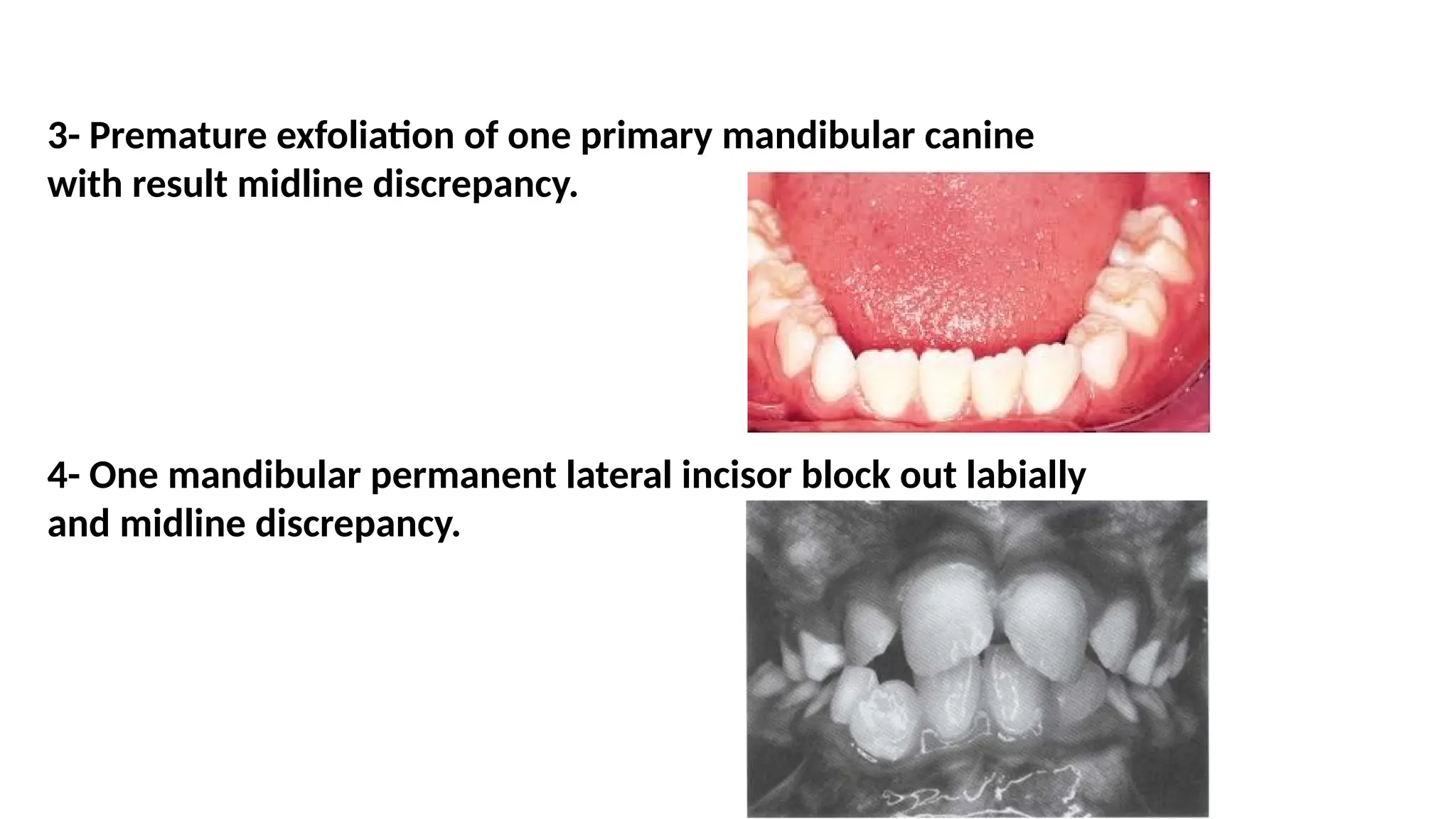 crowding of teeth .pptx management of crowding | PPTX