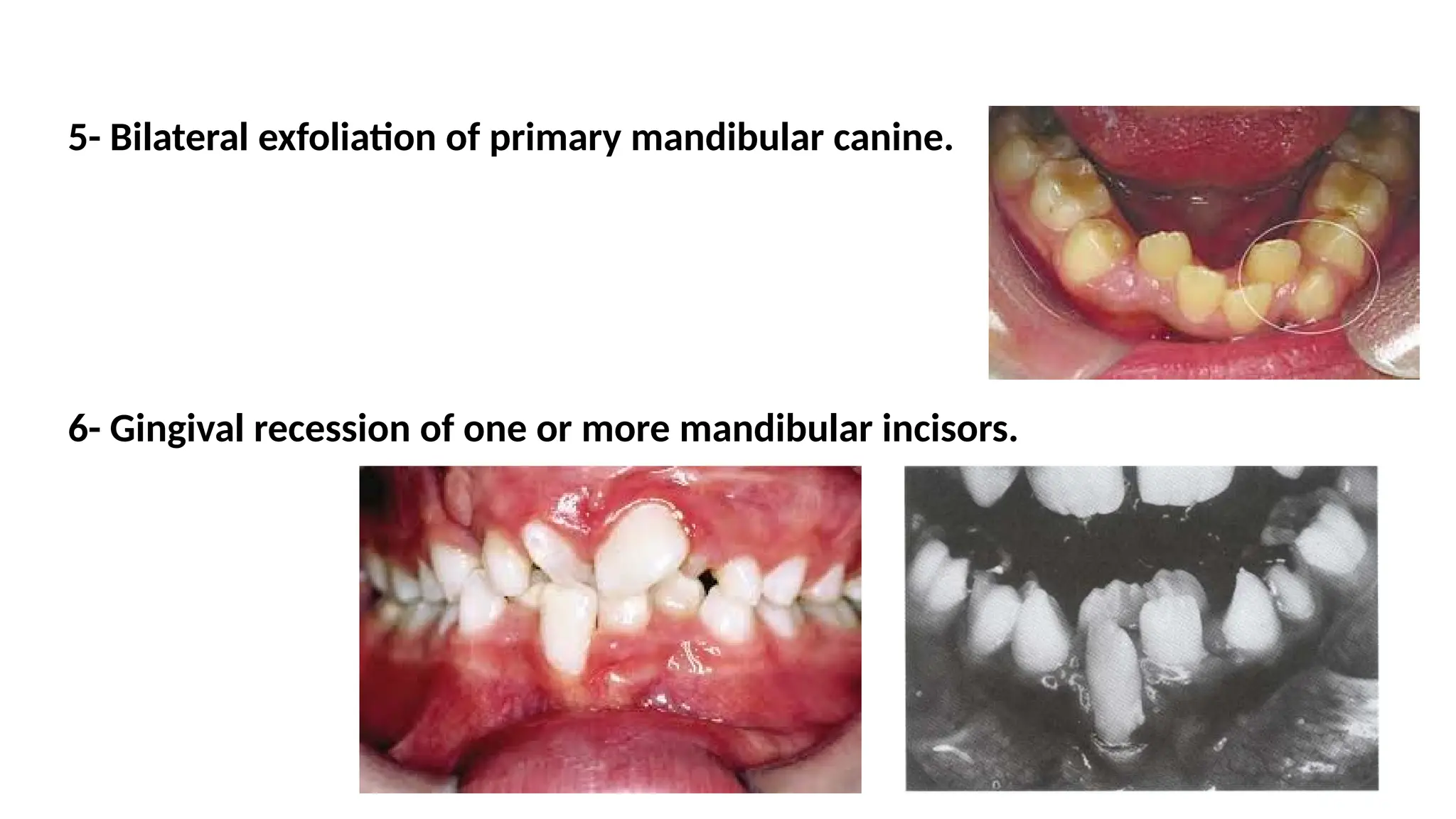 crowding of teeth .pptx management of crowding | PPTX