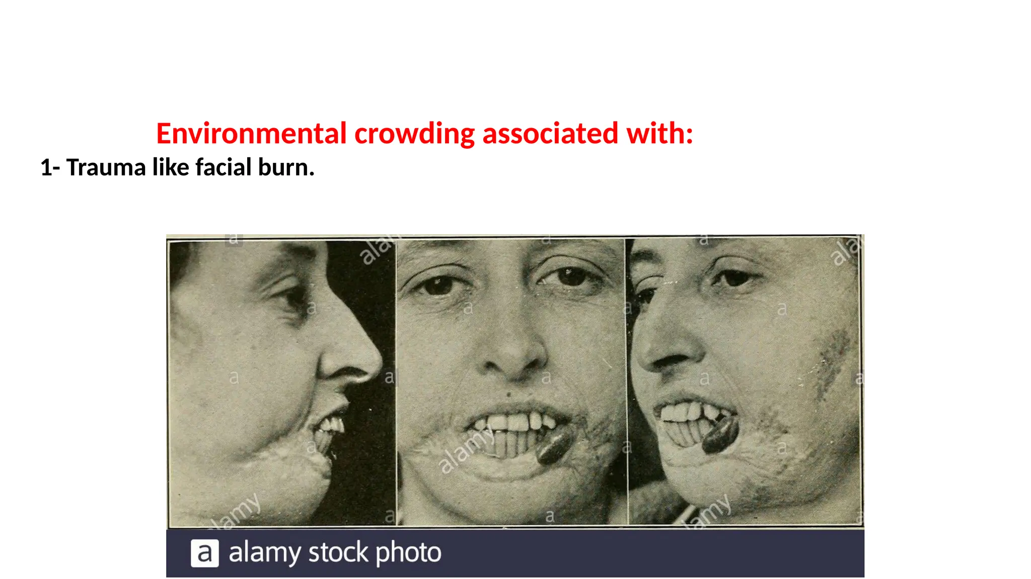 crowding of teeth .pptx management of crowding | PPTX