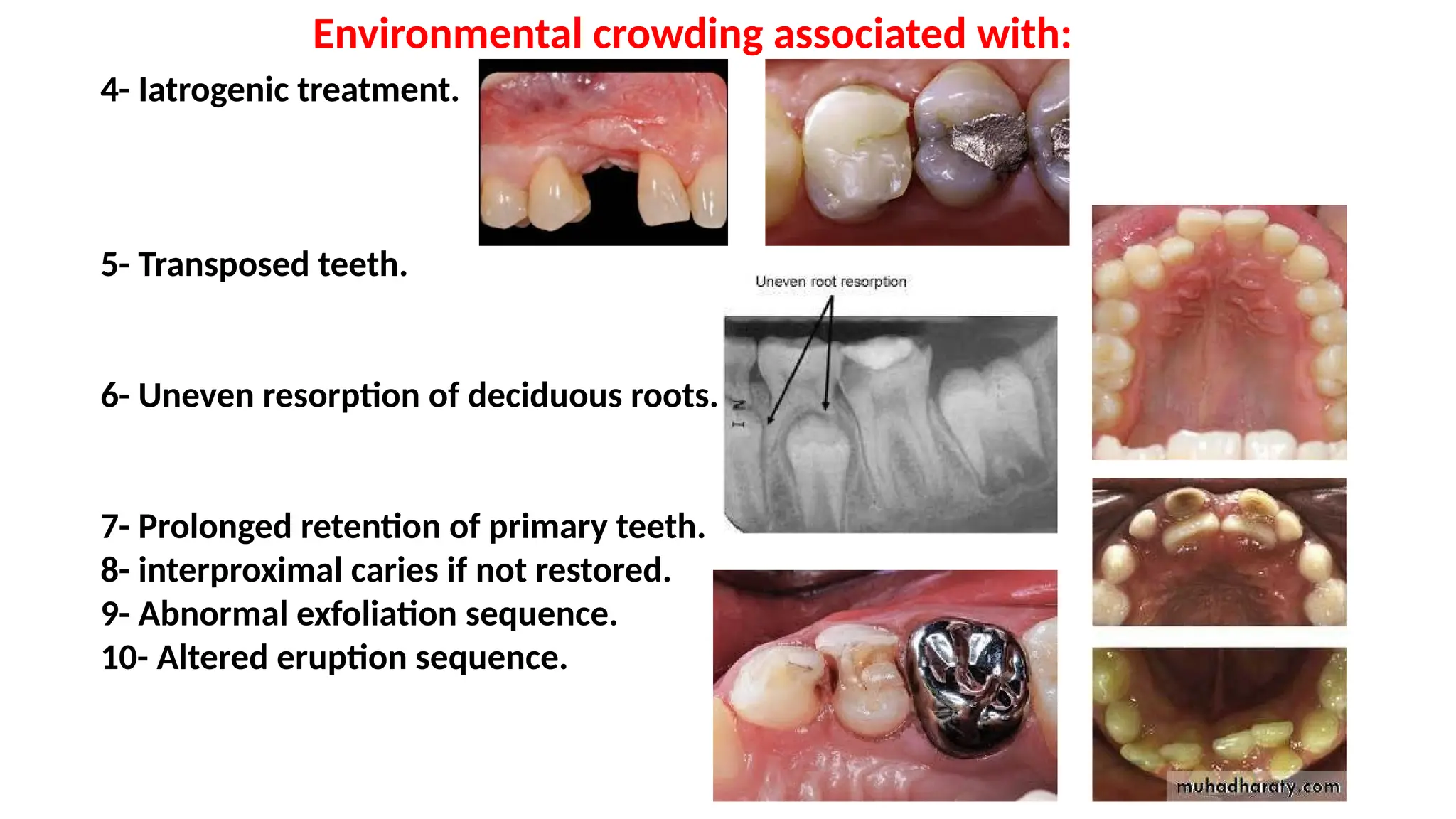 crowding of teeth .pptx management of crowding | PPTX