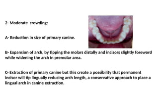 crowding of teeth .pptx management of crowding | PPTX