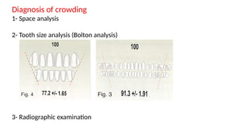 crowding of teeth .pptx management of crowding | PPTX
