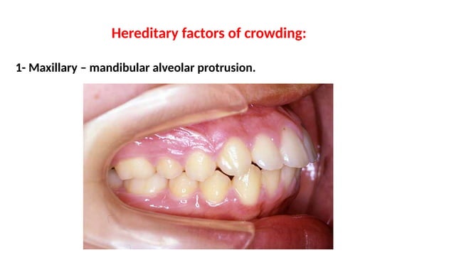 crowding of teeth .pptx management of crowding | PPTX