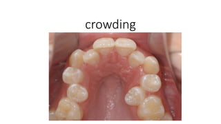 crowding in the dental arch of the human.pptx
