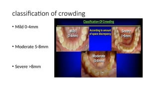 crowding in the dental arch of the human.pptx