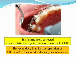 Crowding, extraction, sling shot, and torque | PPT