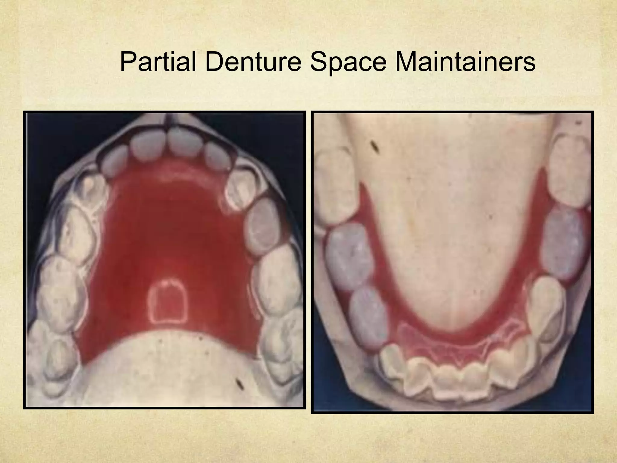 Crowding in mixed dentition.ppt.pptx