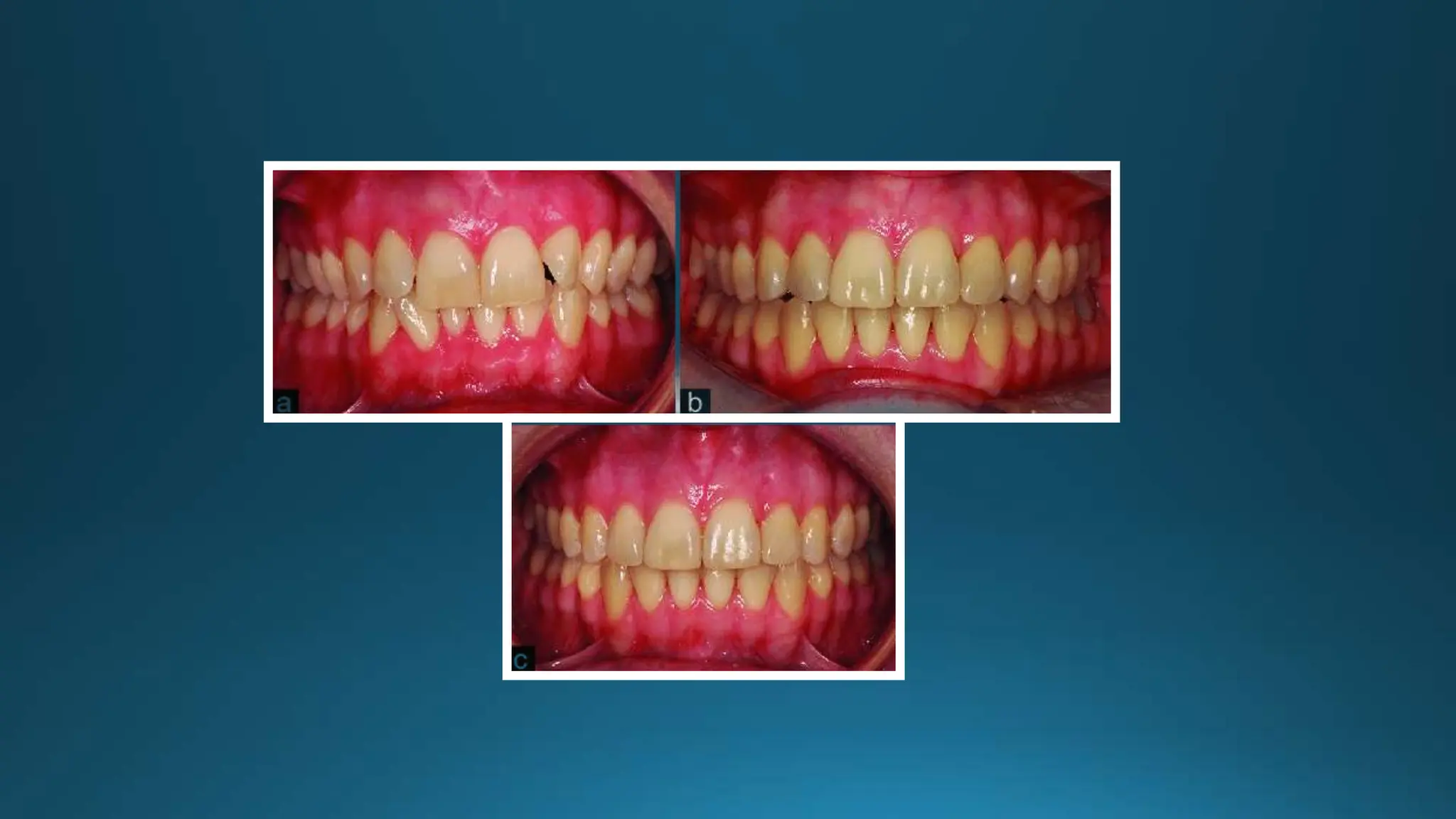 crowding and its management presentation | PPTX | Dental Health ...