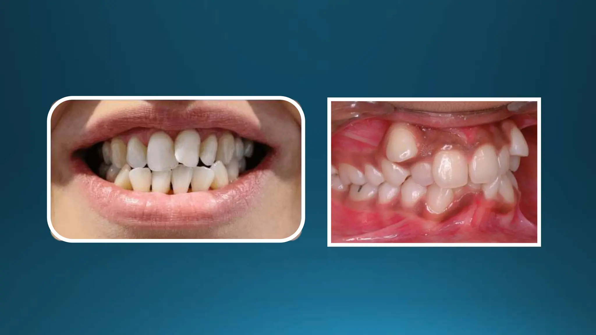 crowding and its management presentation | PPTX | Dental Health ...