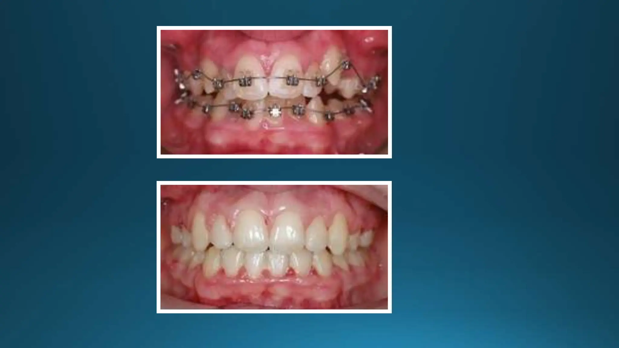 crowding and its management presentation | PPTX | Dental Health ...