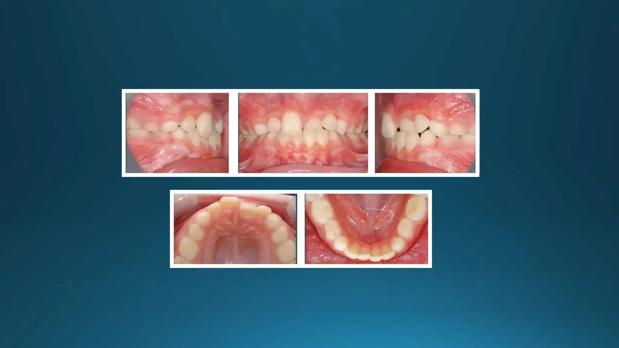 crowding and its management presentation | PPTX | Dental Health ...