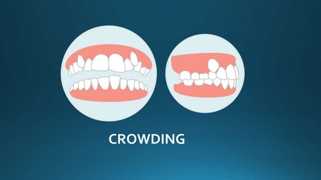 crowding and its management presentation | PPTX | Dental Health | Diseases and Conditions