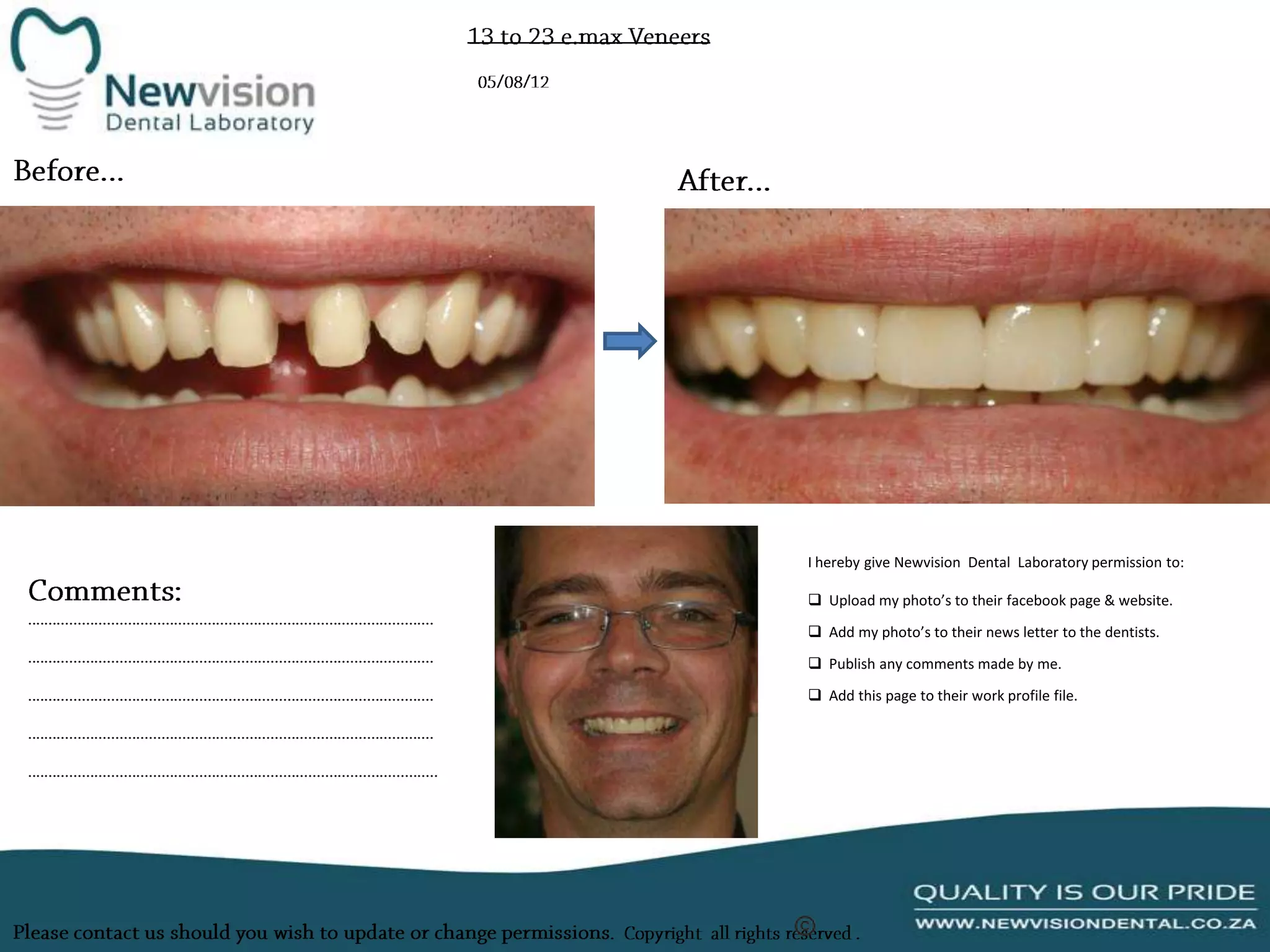Crown and bridge emax work presentation | PPTX