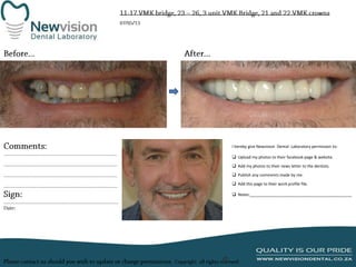 Crown and bridge vmk and bruxir work presentation | PPT