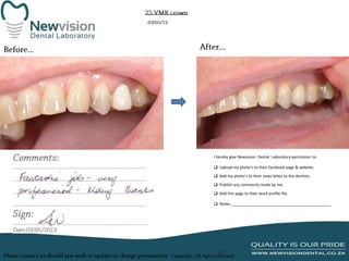 Crown and bridge vmk and bruxir work presentation | PPT