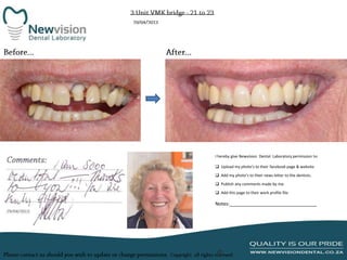 Crown and bridge vmk and bruxir work presentation | PPT