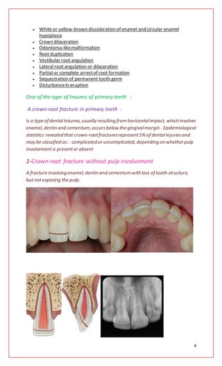 Crown and root fracture in primary teeth | DOCX