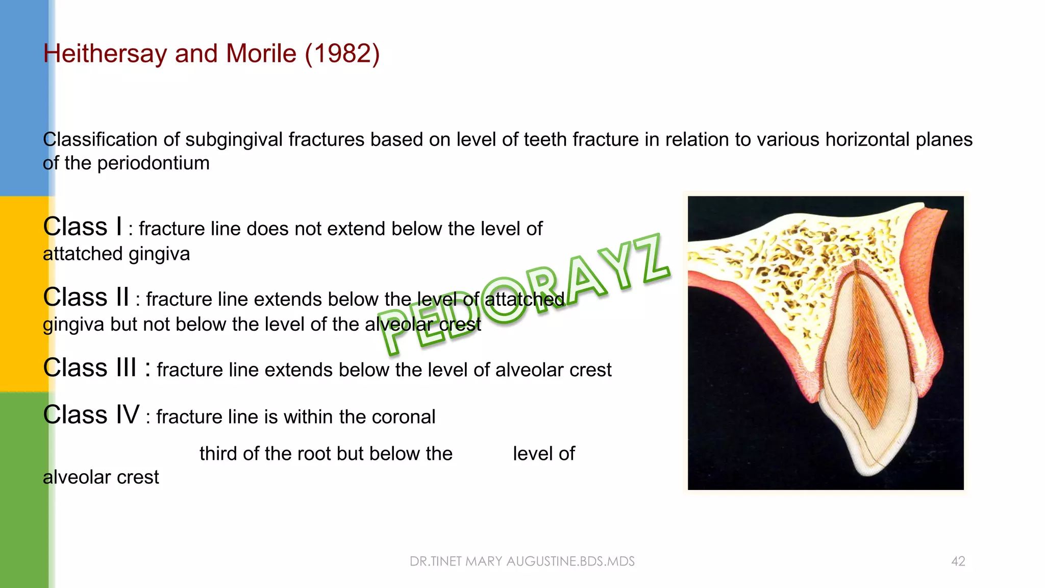 Dental Crown fracture | PDF