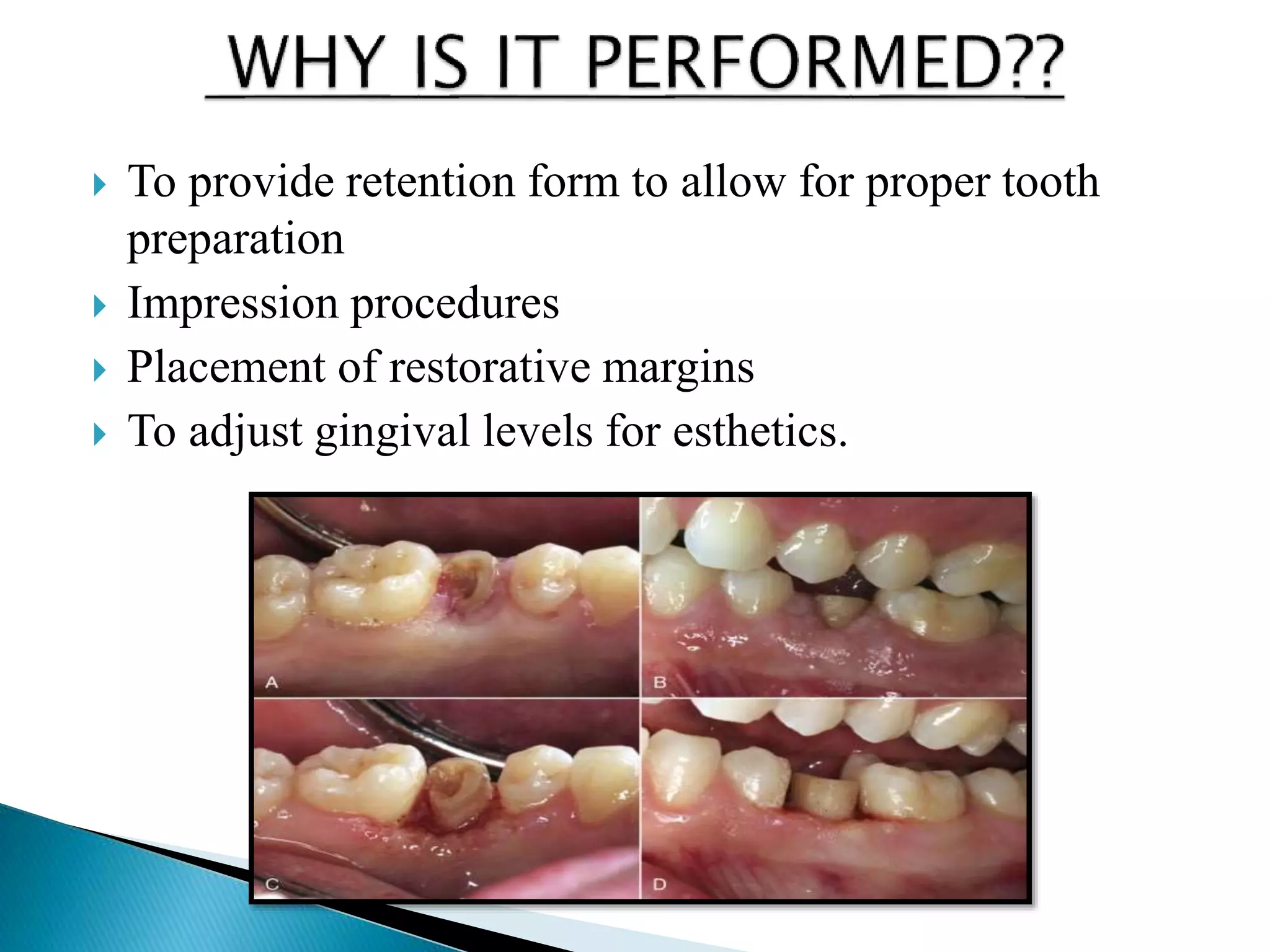 Crown lengthening | PPTX