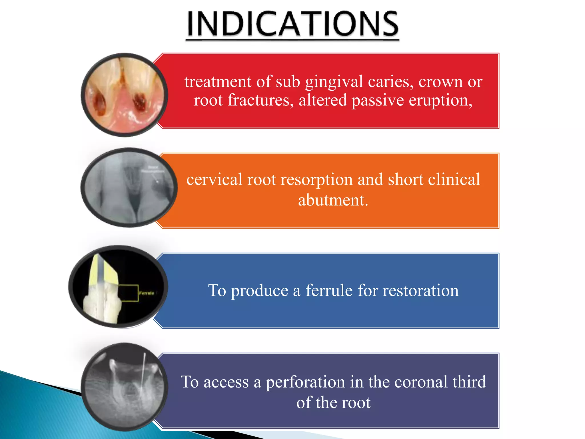 Crown lengthening | PPTX