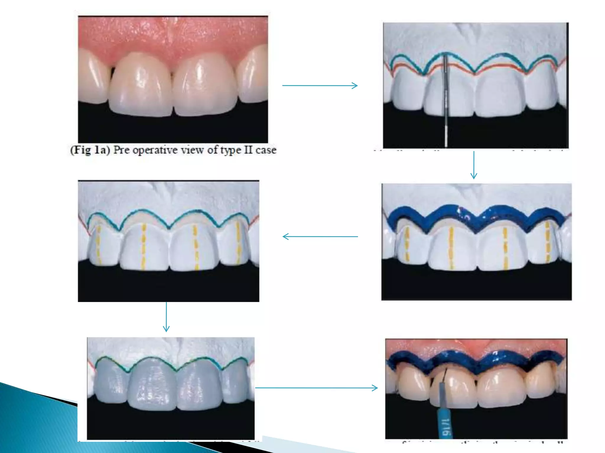 Crown lengthening | PPTX