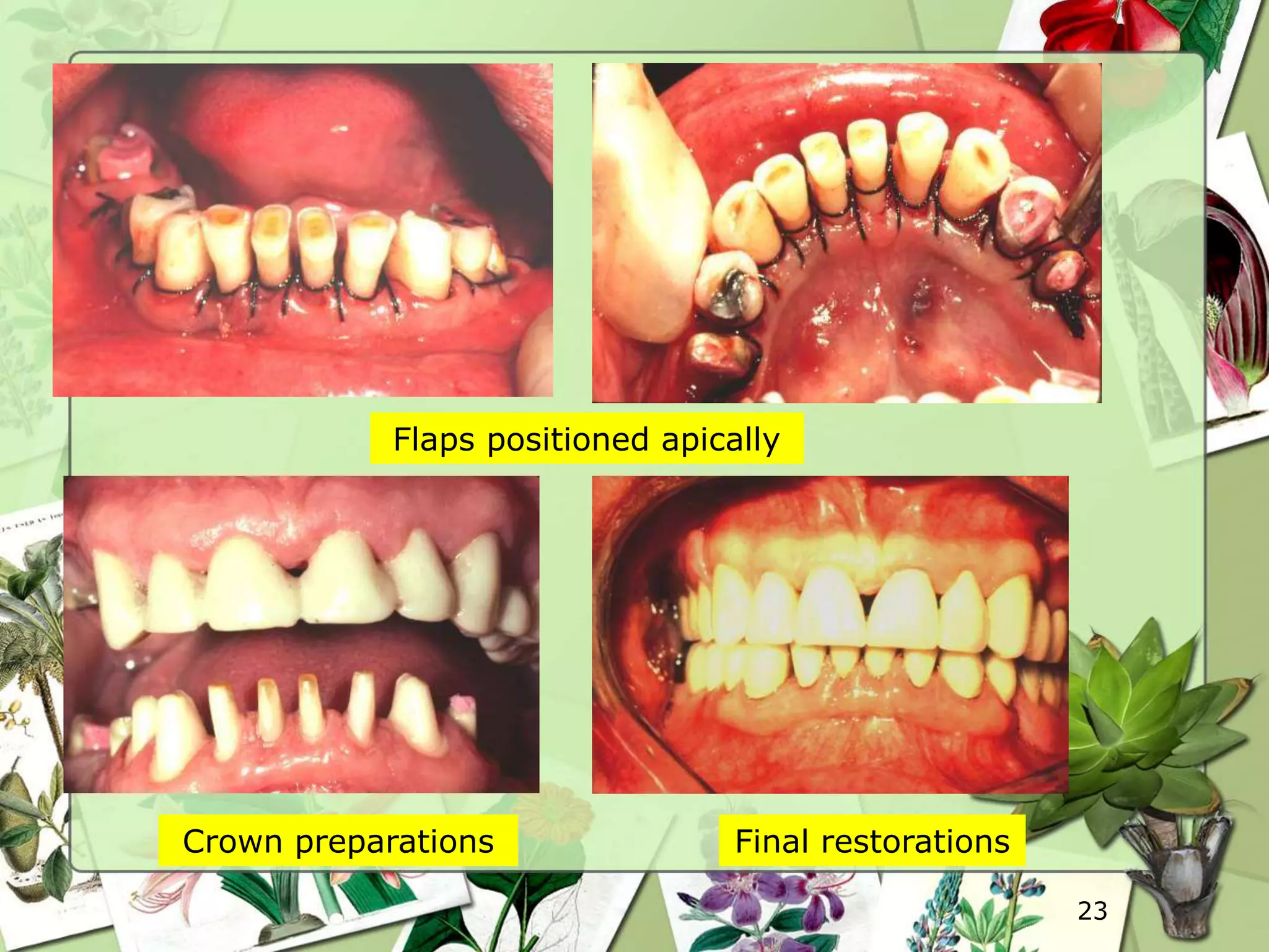 crown lengthening.pptx