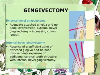 crown lengthening.pptx | Dental Health | Diseases and Conditions