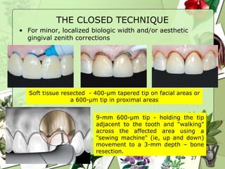 crown lengthening.pptx