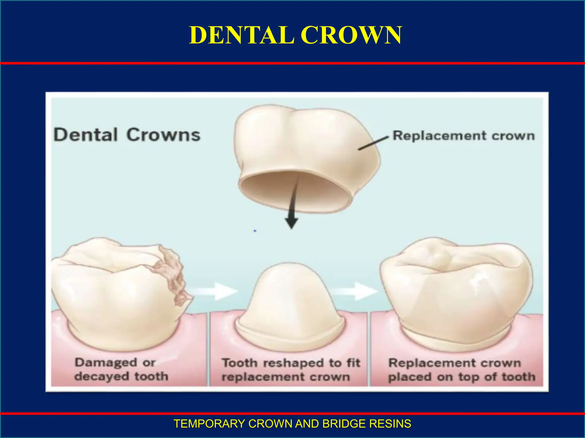 endodontics crown and bridge restoration ppt.pptx