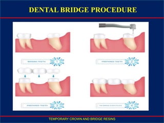 endodontics crown and bridge restoration ppt.pptx