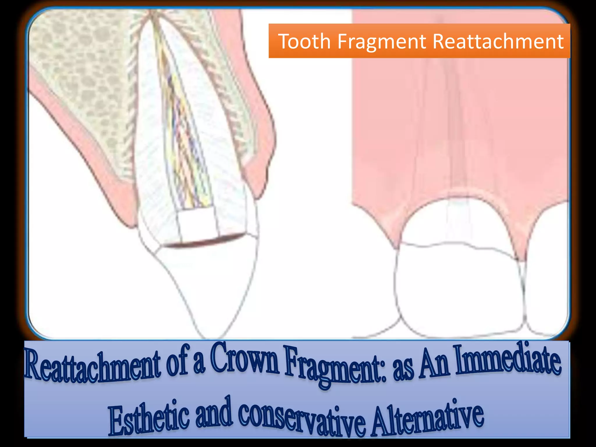 Crown reattachment | PPTX