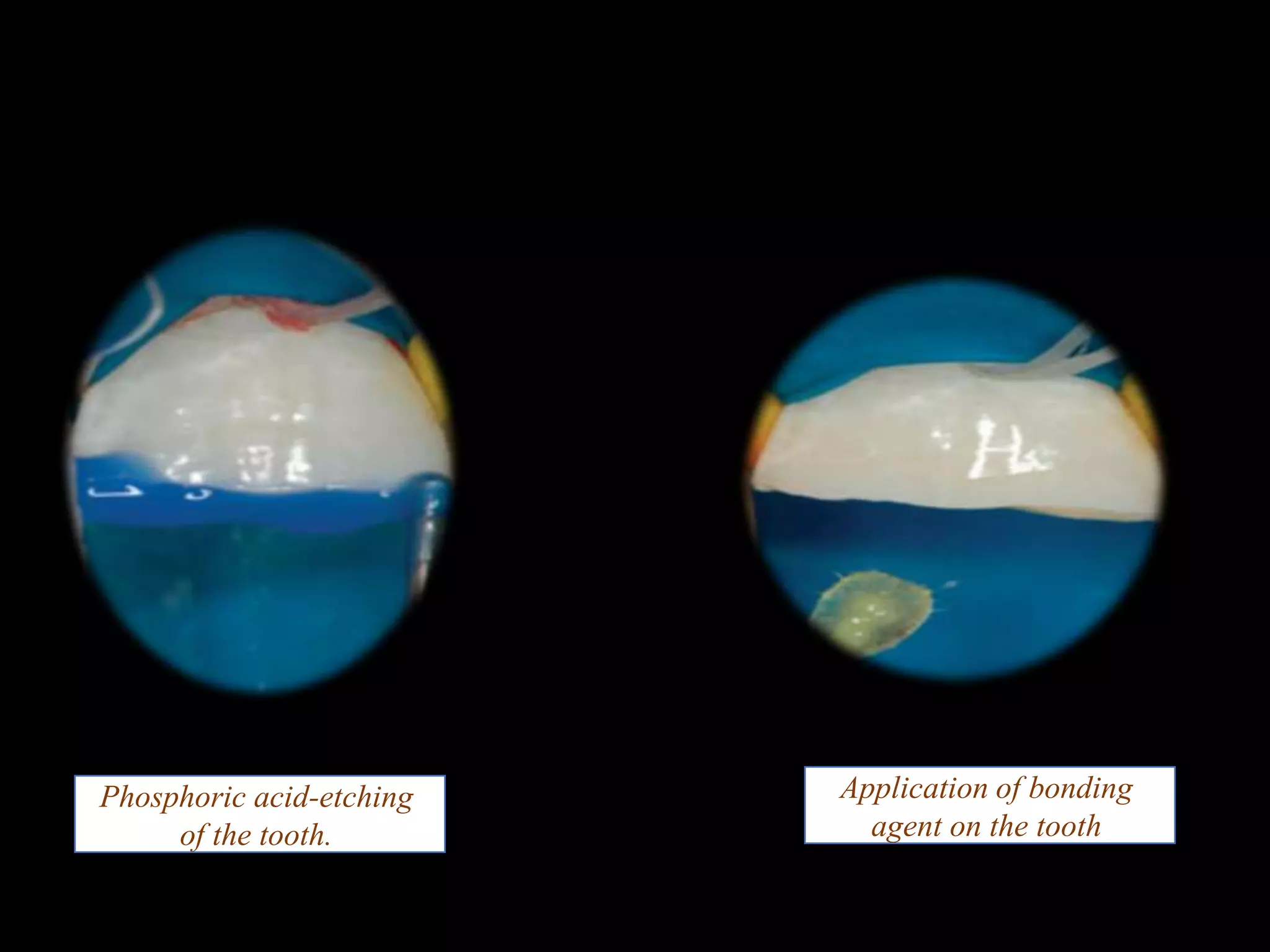 Crown reattachment | PPTX