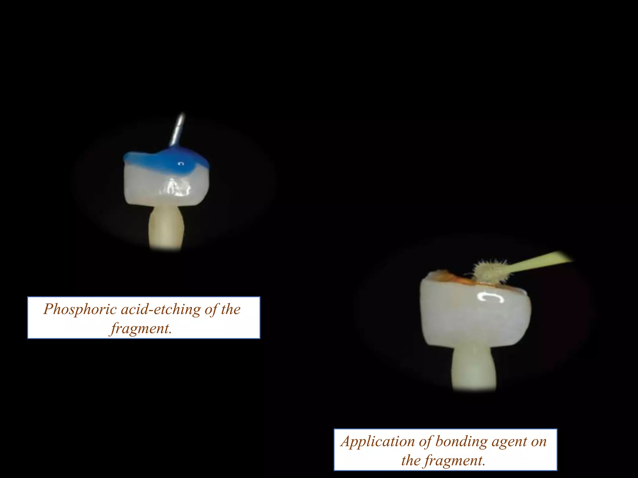 Crown reattachment | PPTX