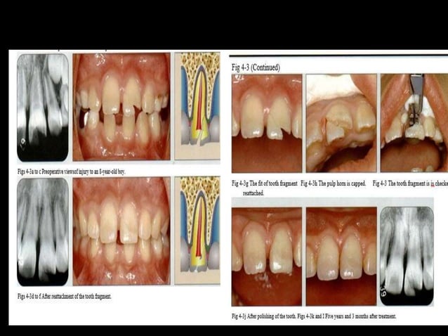 Crown reattachment | PPTX