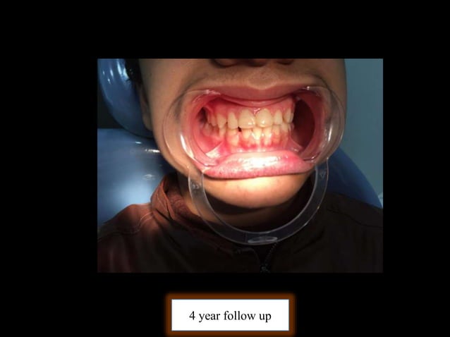 Crown reattachment | PPTX