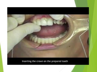 Crown try in and supply | PPTX