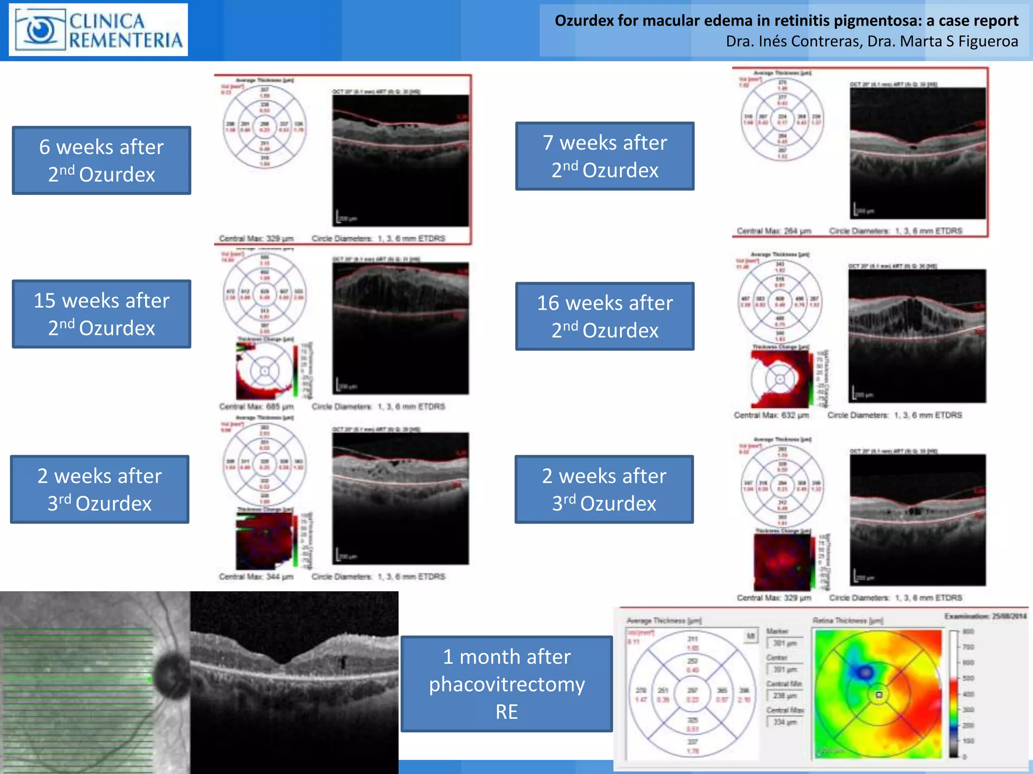 Ozurdex for macular edema in retinitis pigmentosa | PPTX