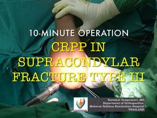 10-minute Operation : Close Reduction with Percutaneous Pinning in ...