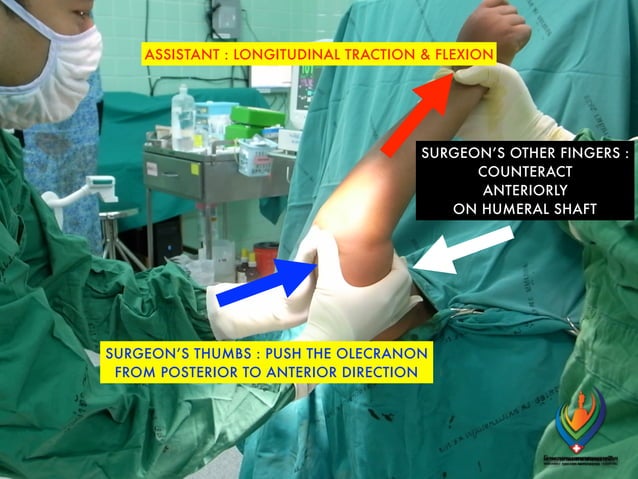10-minute Operation : Close Reduction with Percutaneous Pinning in ...