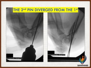 10-minute Operation : Close Reduction with Percutaneous Pinning in ...