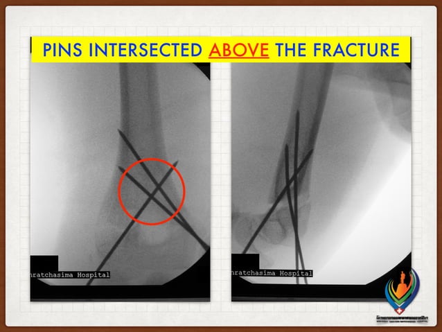 10-minute Operation : Close Reduction with Percutaneous Pinning in ...