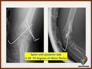 Percutaneous Pinning