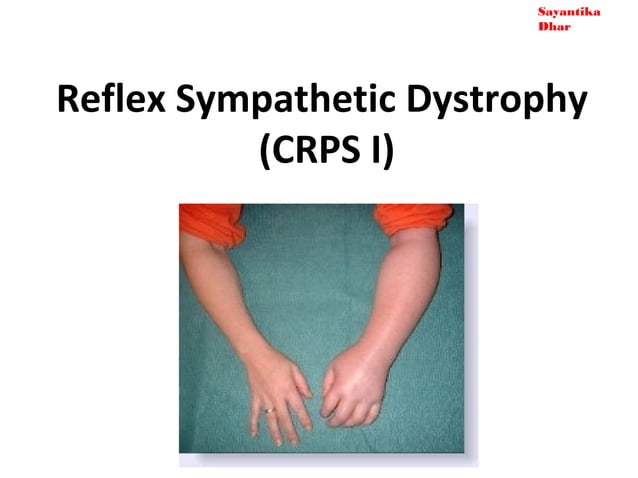 Reflex Sympathetic Dystrophy (CRPS 1) | PPT | Physical Therapy | Wellness
